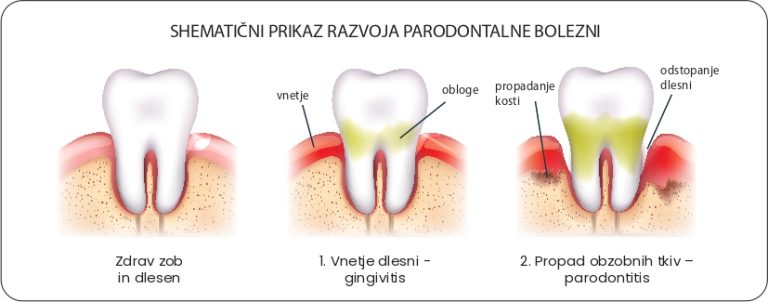 Kaj je parodontoza? - Žurnal24 priporoča